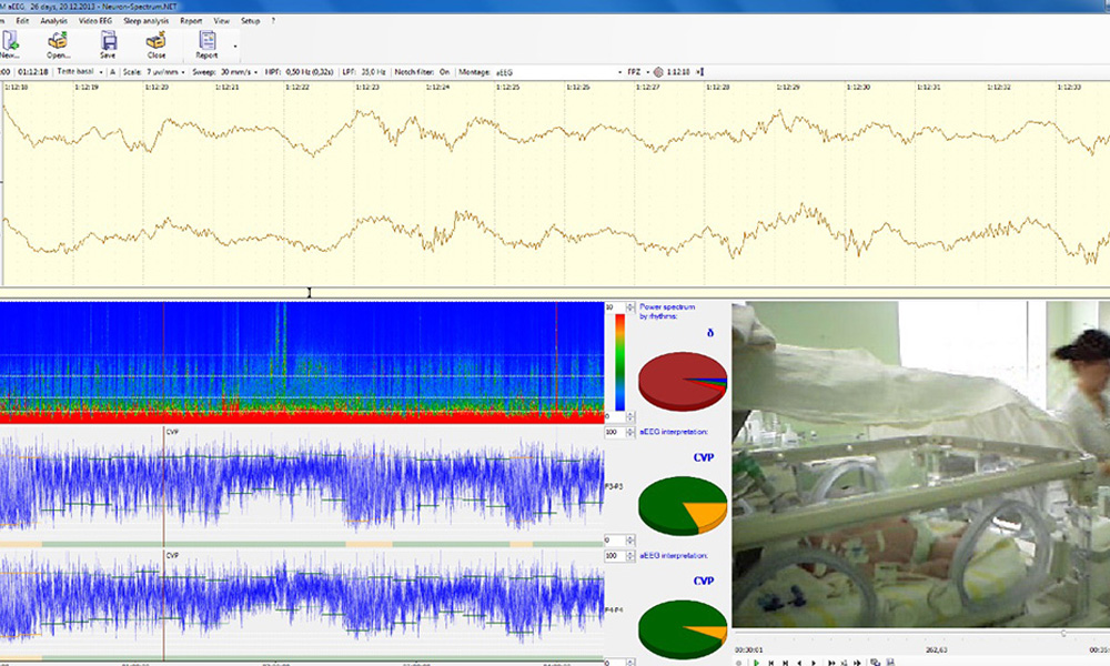 Monitor FC/aEEG - Soluciones para Neurofisiologia y Neurorehabilitacion